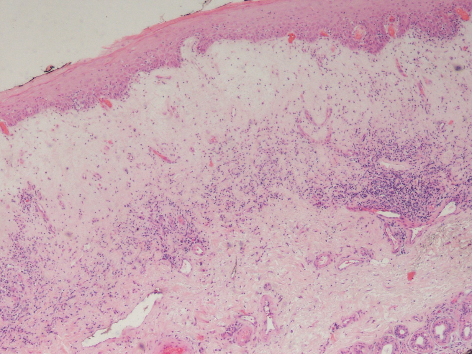 Week 614: Case 3 | Johns Hopkins Surgical Pathology Unknown Conference
