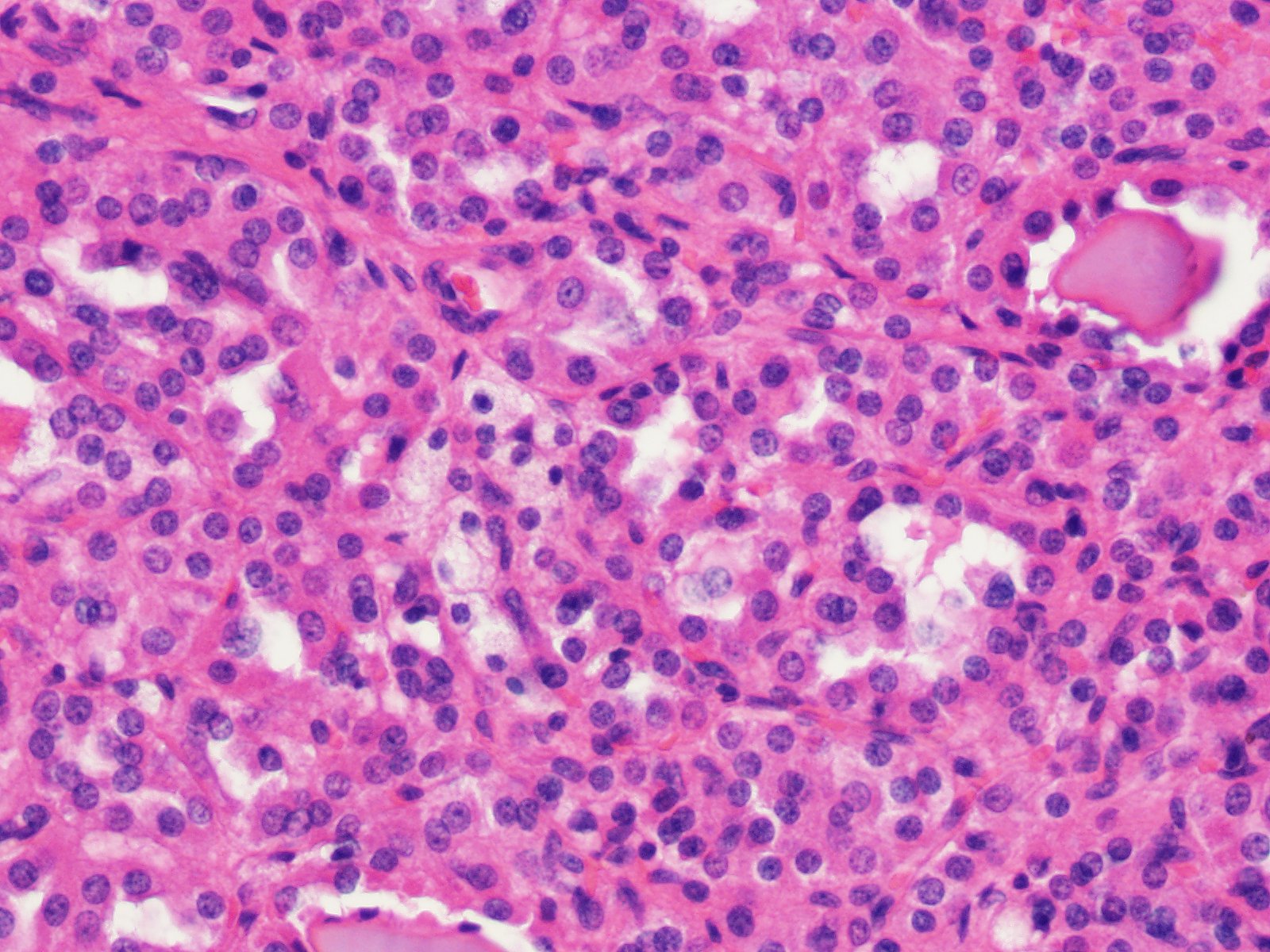 Week 617: Case 3 | Johns Hopkins Surgical Pathology Unknown Conference