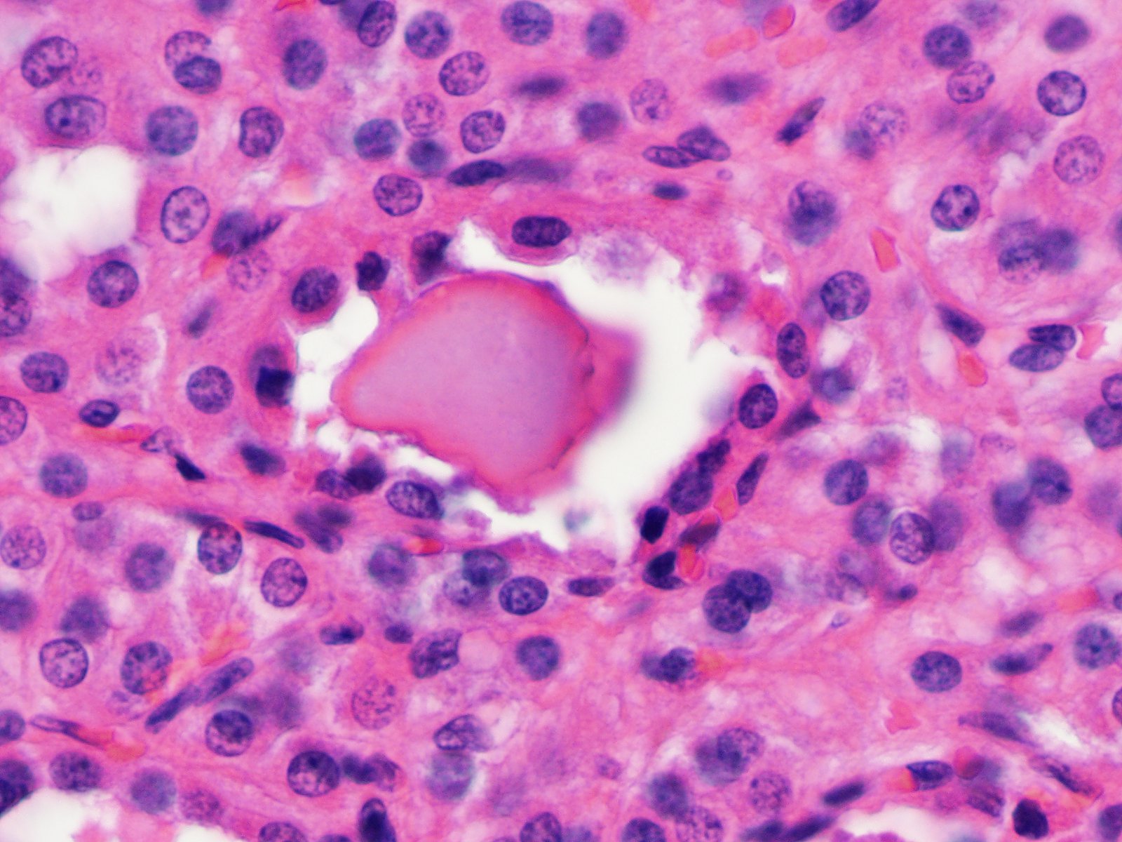 Week 617: Case 3 | Johns Hopkins Surgical Pathology Unknown Conference