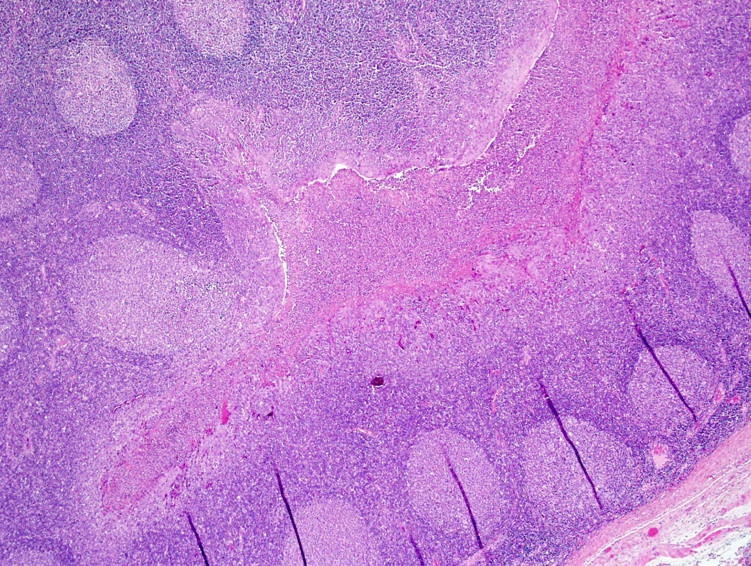 Week 618: Case 1 | Johns Hopkins Surgical Pathology Unknown Conference