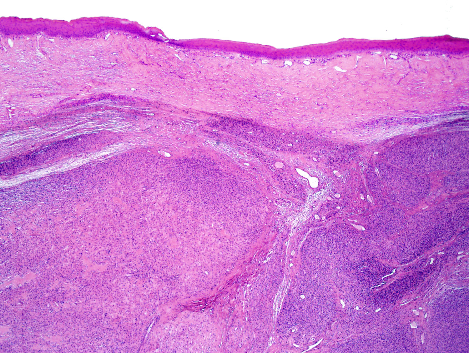 Week 625: Case 1 | Johns Hopkins Surgical Pathology Unknown Conference