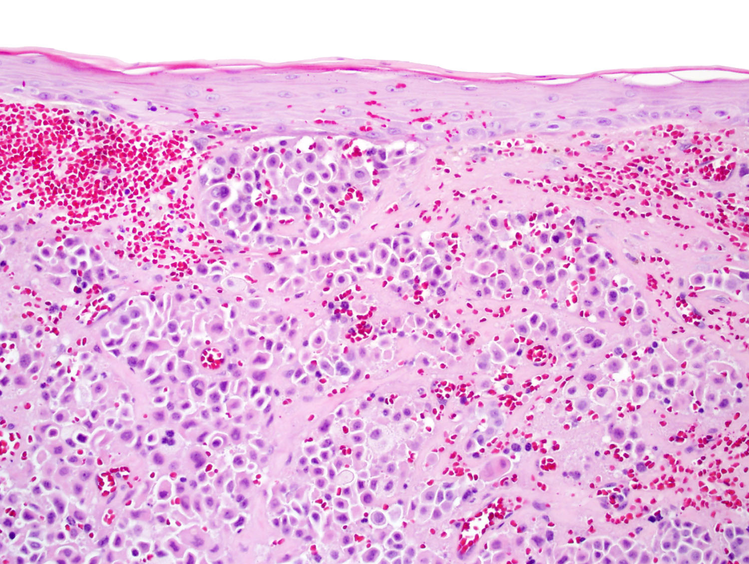 Week 625: Case 2 | Johns Hopkins Surgical Pathology Unknown Conference