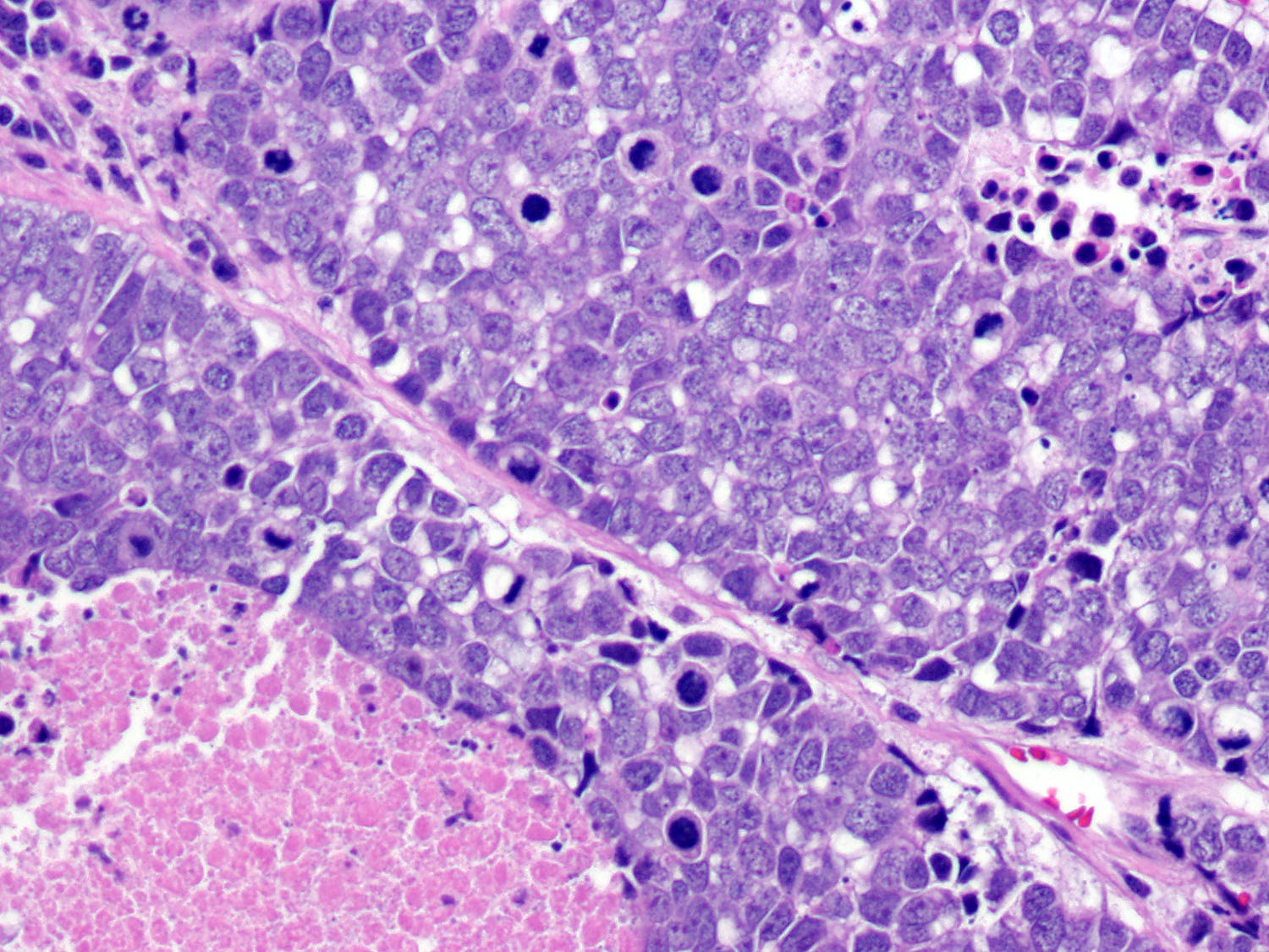 Week 625: Case 3 | Johns Hopkins Surgical Pathology Unknown Conference