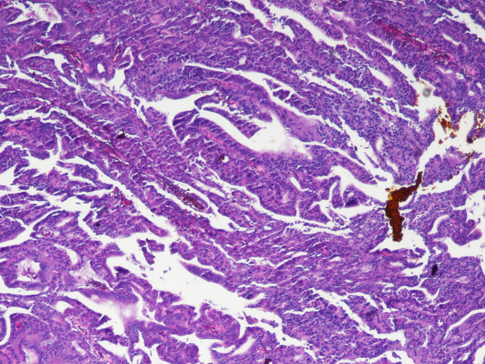 Week 647: Case 2 | Johns Hopkins Surgical Pathology Unknown Conference
