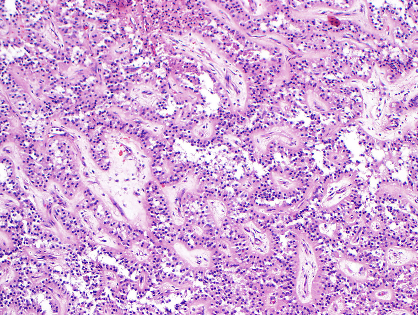 Week 653: Case 1 | Johns Hopkins Surgical Pathology Unknown Conference