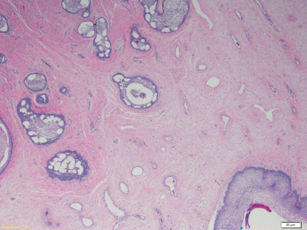 Week 658: Case 3 | Johns Hopkins Surgical Pathology Unknown Conference