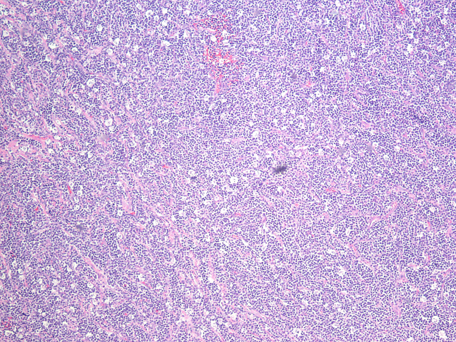 Week 660: Case 3 | Johns Hopkins Surgical Pathology Unknown Conference