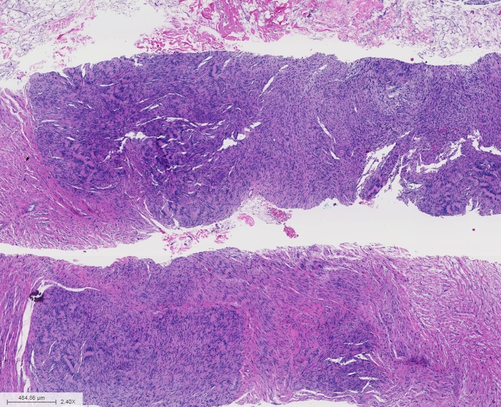 Week 685: Case 2 | Johns Hopkins Surgical Pathology Unknown Conference
