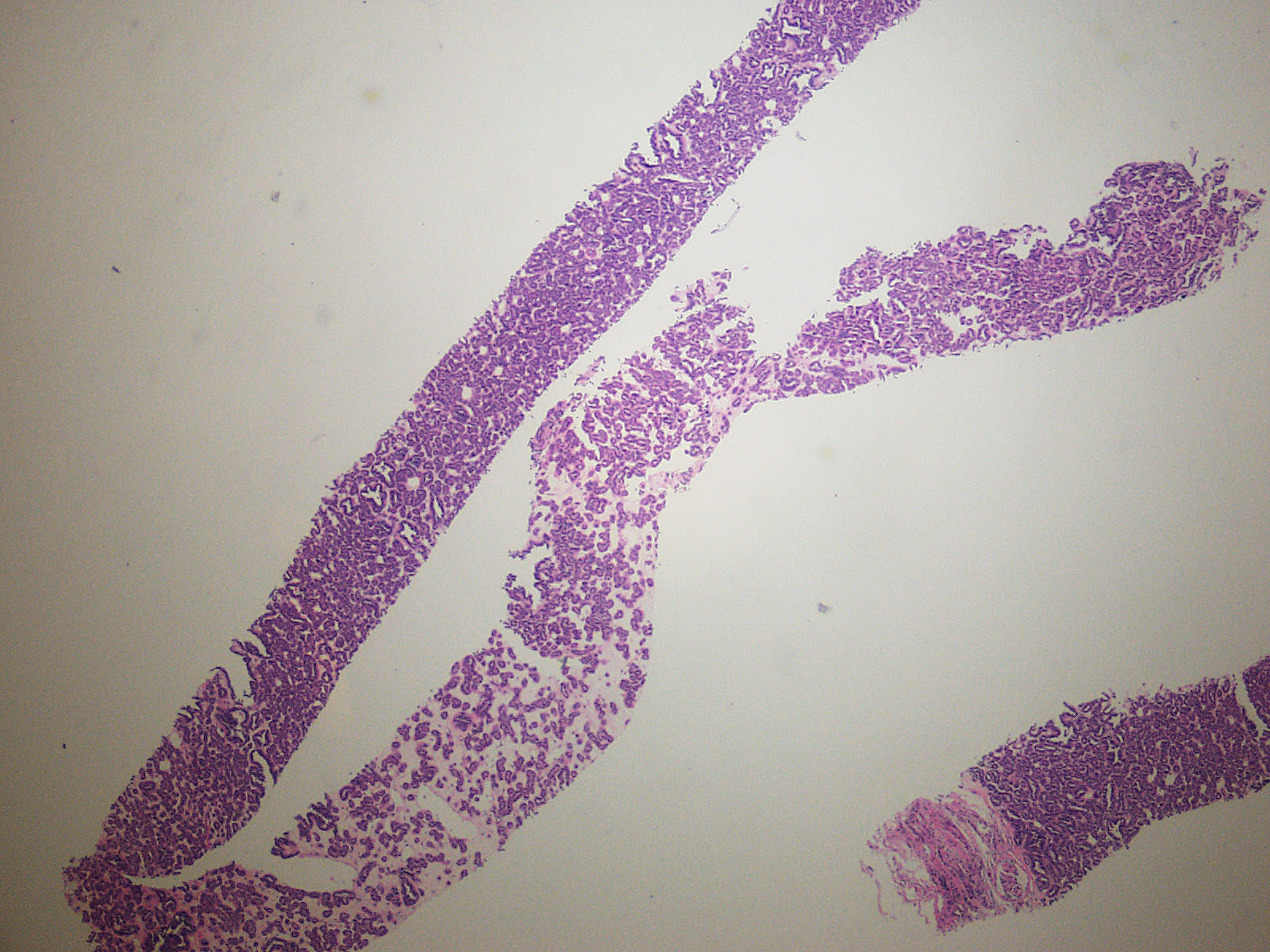 Week 690: Case 3 | Johns Hopkins Surgical Pathology Unknown Conference