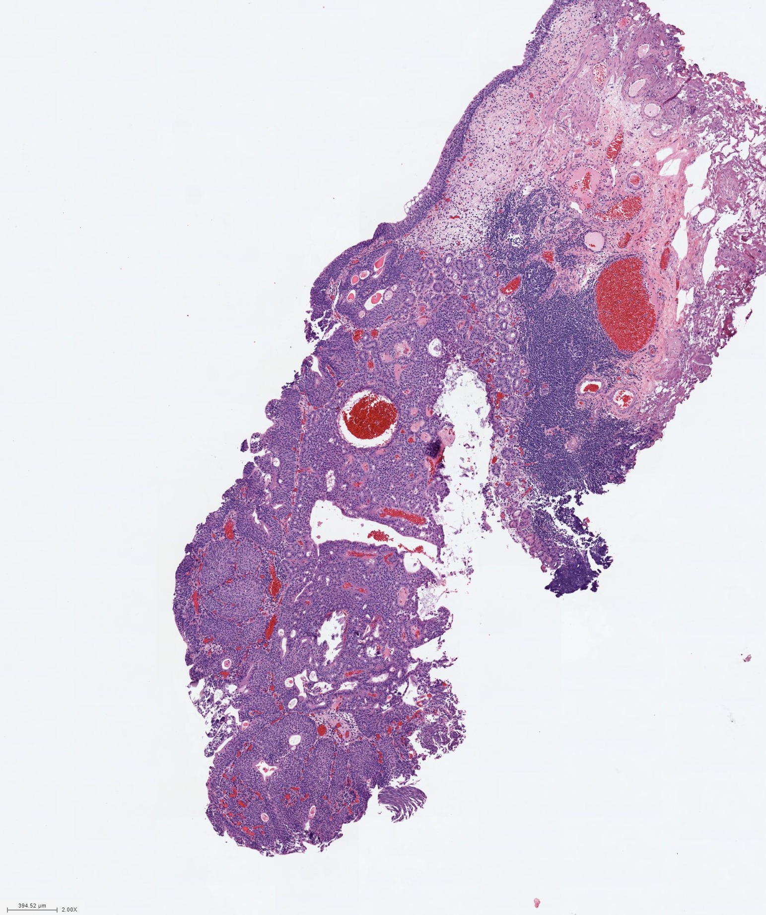 Week 691: Case 2 | Johns Hopkins Surgical Pathology Unknown Conference