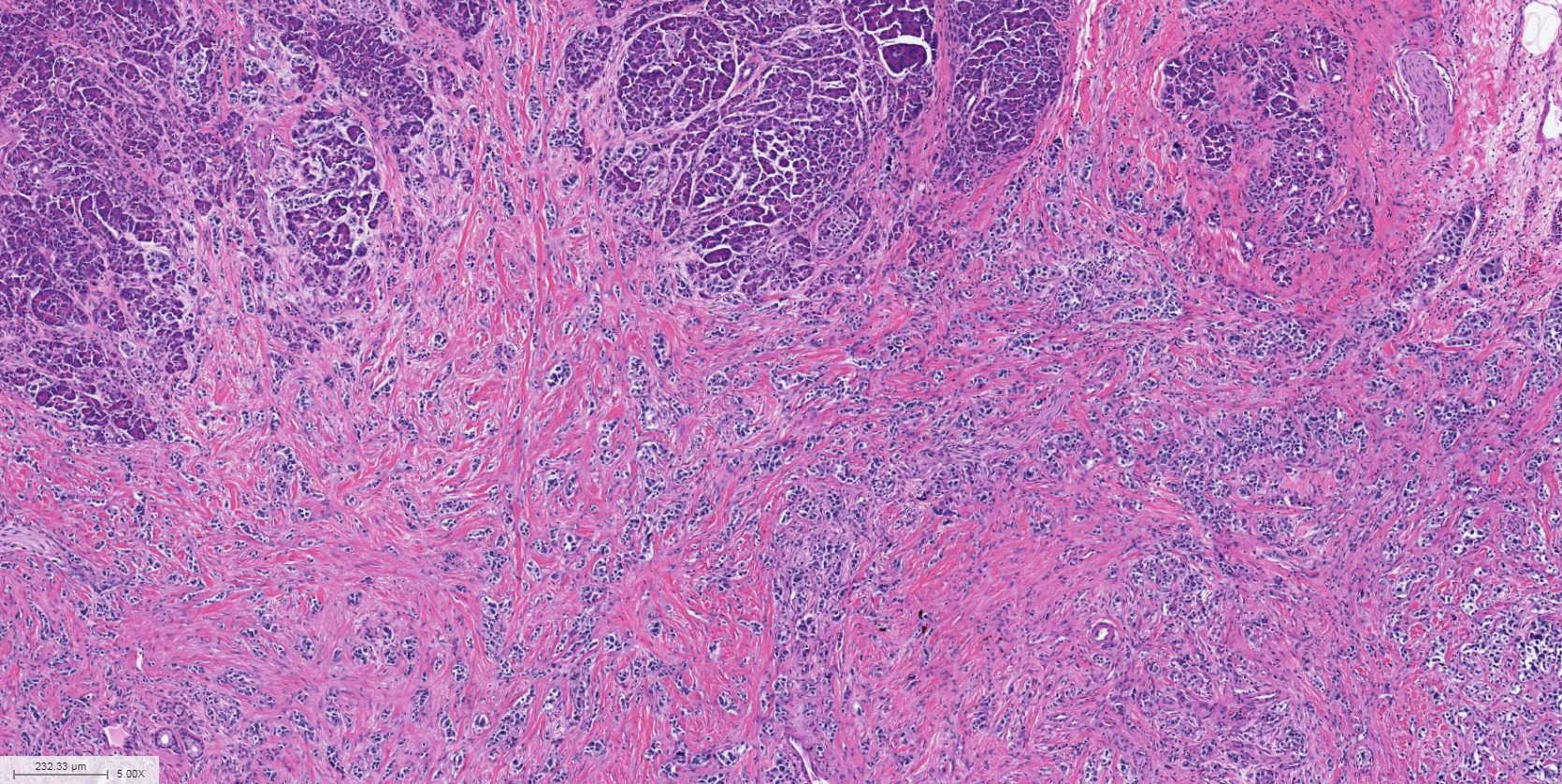 Week 692: Case 2 | Johns Hopkins Surgical Pathology Unknown Conference