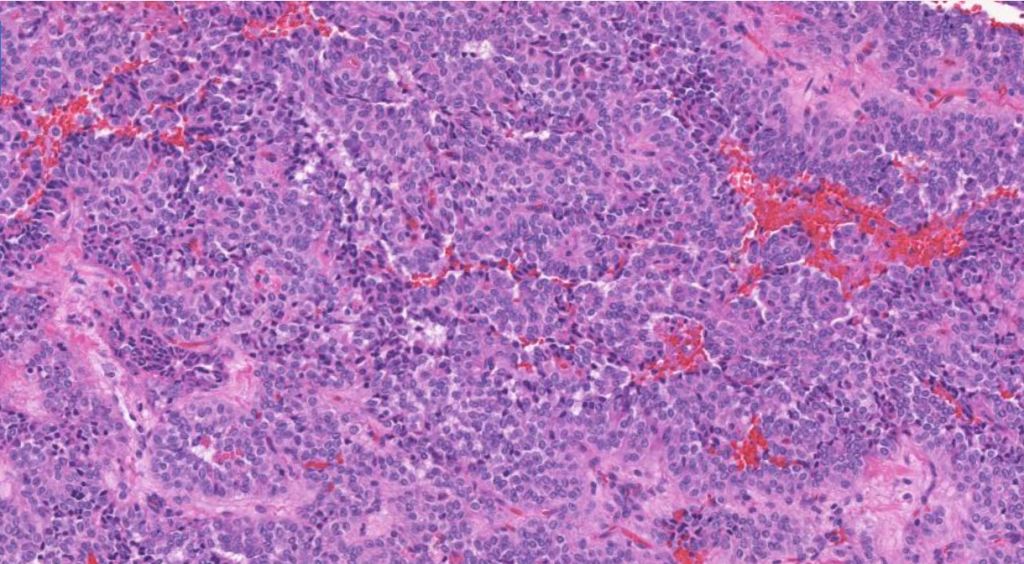 Week 753: Case 1 | Johns Hopkins Surgical Pathology Unknown Conference