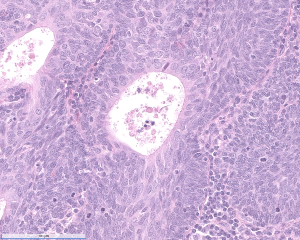 Week 774: Case 1 | Johns Hopkins Surgical Pathology Unknown Conference