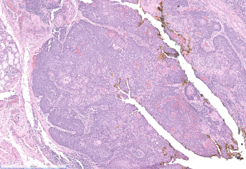 Week 774: Case 1 | Johns Hopkins Surgical Pathology Unknown Conference